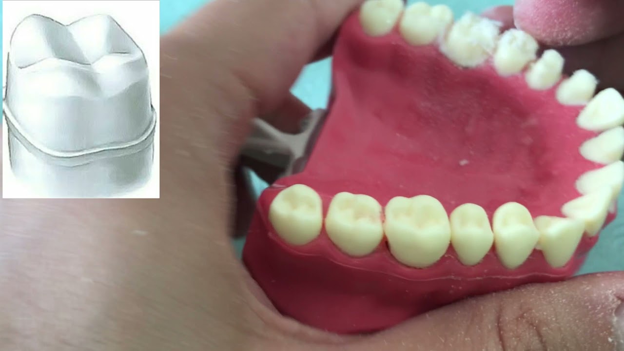 CROWN PREPARATION TUTORIAL (MAXILLARY MOLAR) - YouTube