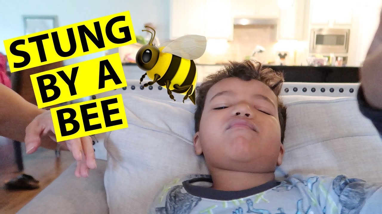 Bad Allergic Reaction - YouTube