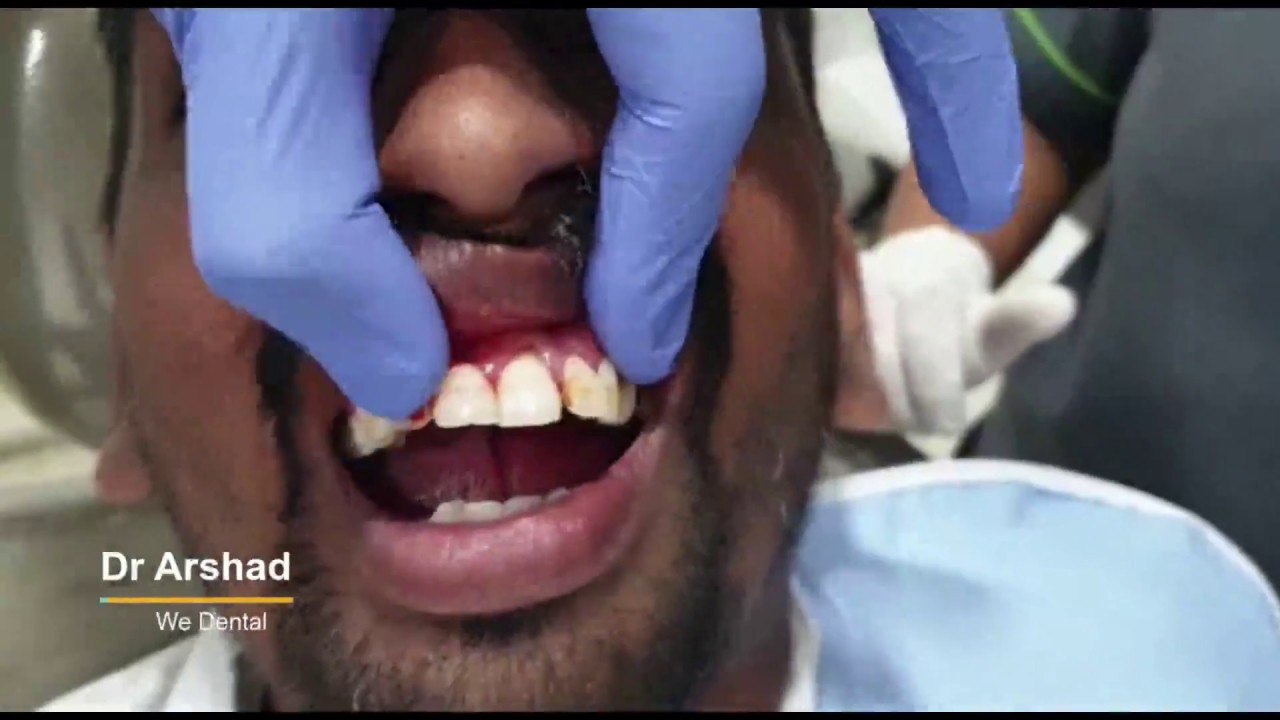 Extraction of upper teeth - We Dental - YouTube