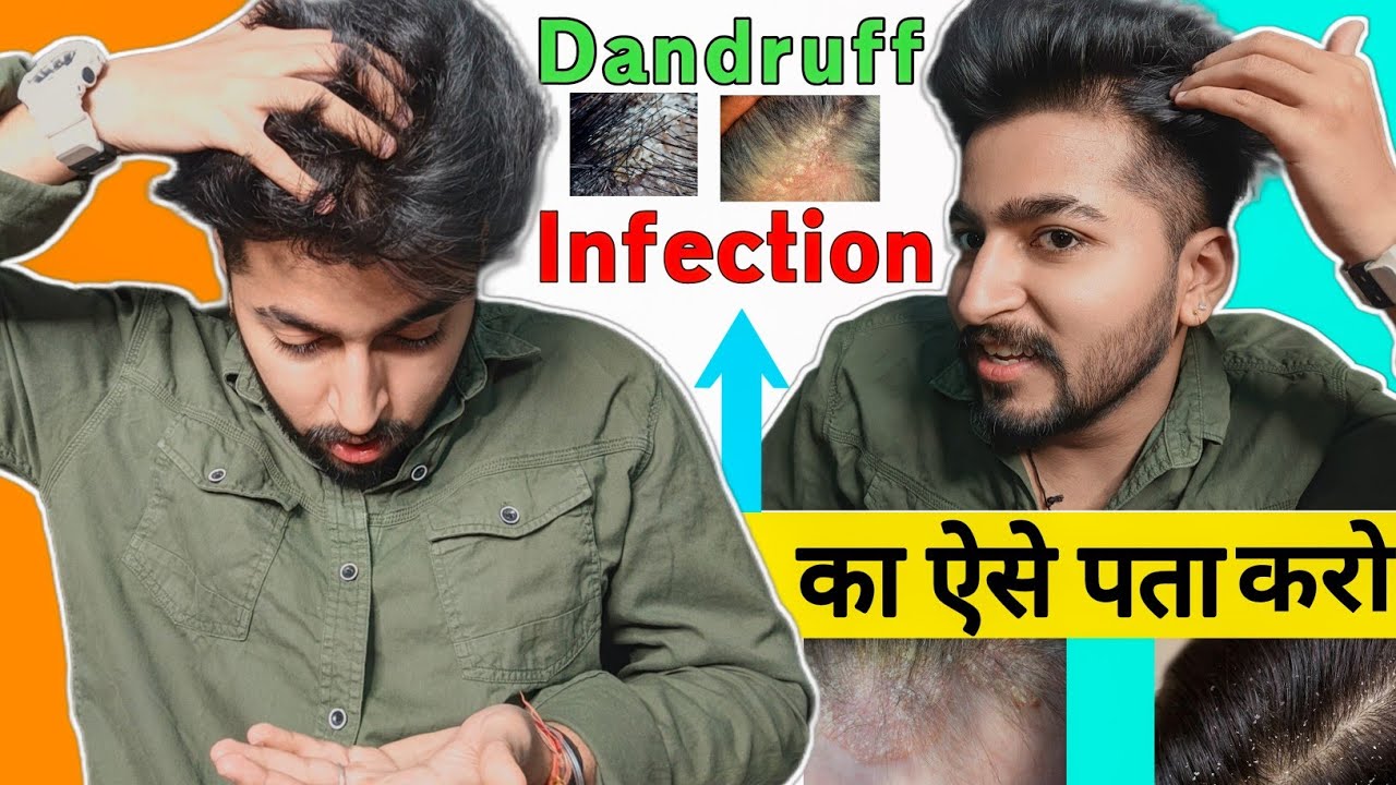 Dandruff, Infection का ऐसे पता करो | How to Find Dandruff, Infection on ...