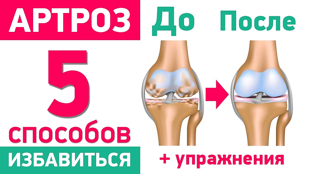 5 способов для здоровья суставов при артрозе Youtube