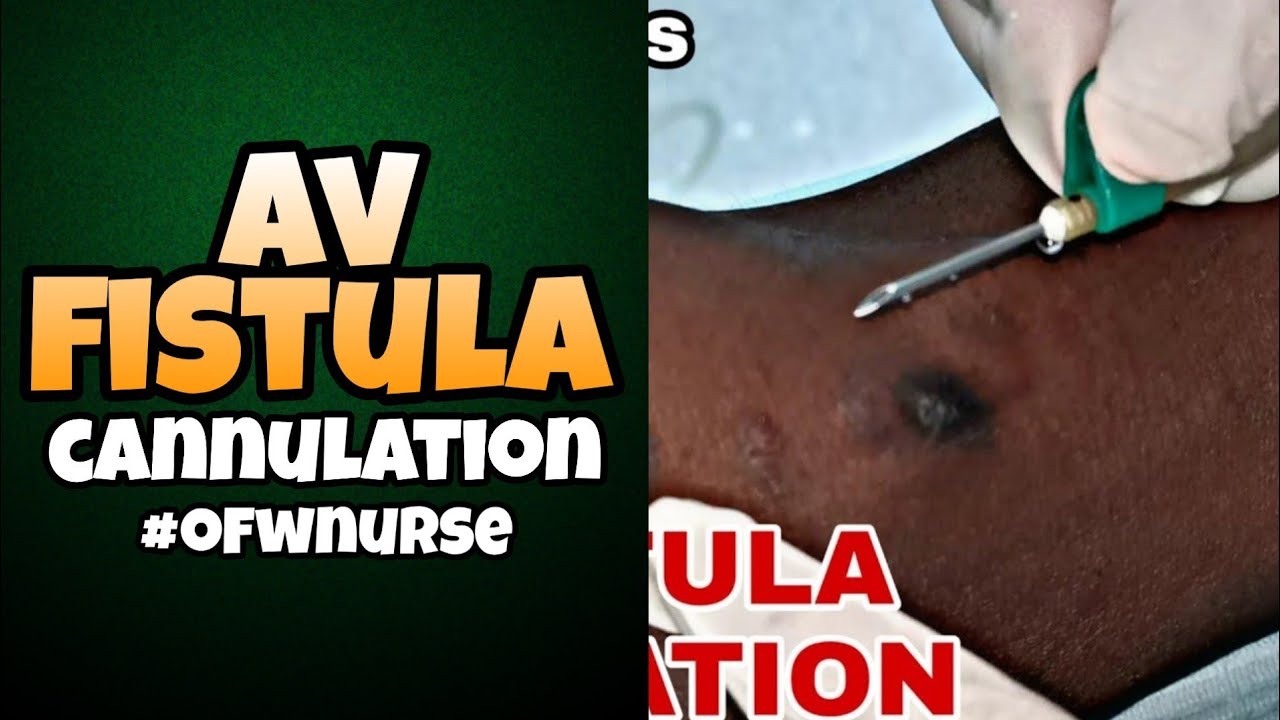 HEMODIALYSIS : QUICK AV FISTULA CANNULATION, HOW TO - YouTube
