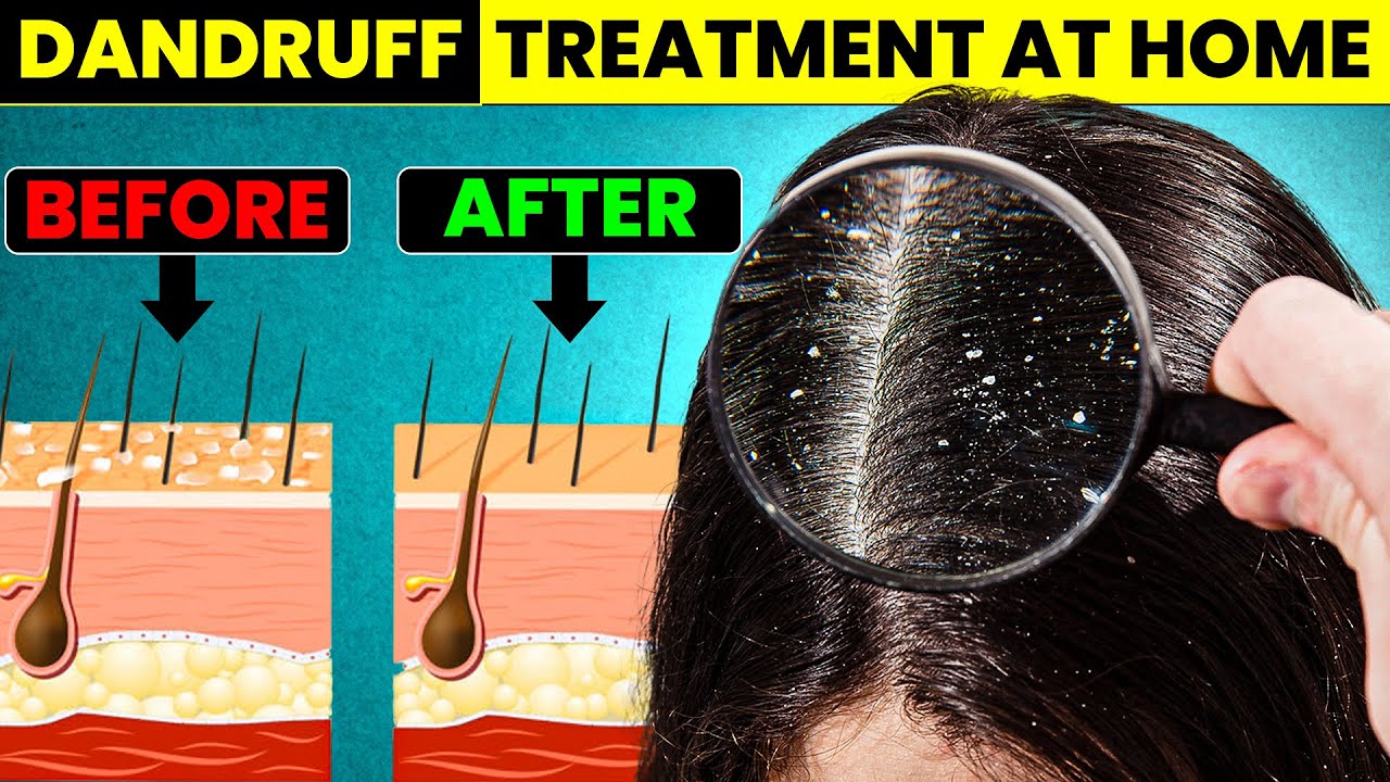 Dandruff Treatment At Home Dandruff Removal Hair Care And Hair Loss