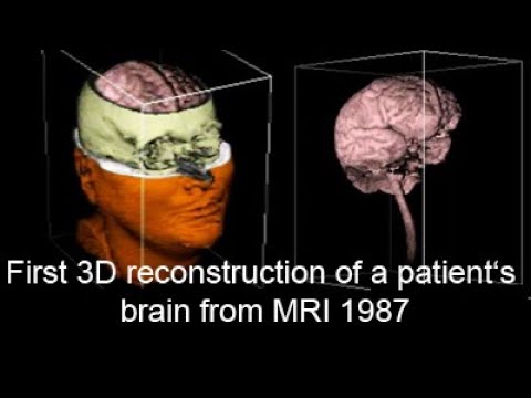 First 3D reconstruction of a patient‘s brain from MRI 1987 - YouTube