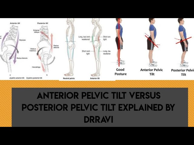 Posterior Pelvic Tilt