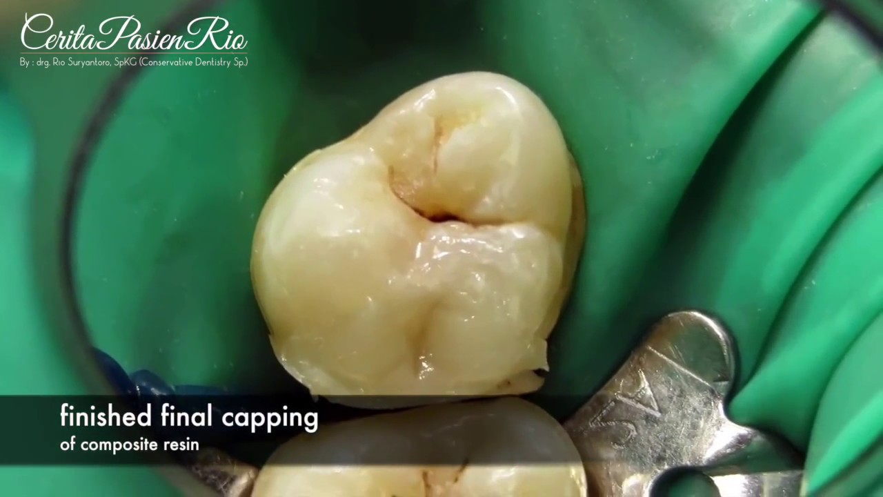 Restoration of class II cavity on maxillary 2nd molar (tambalan gigi ...