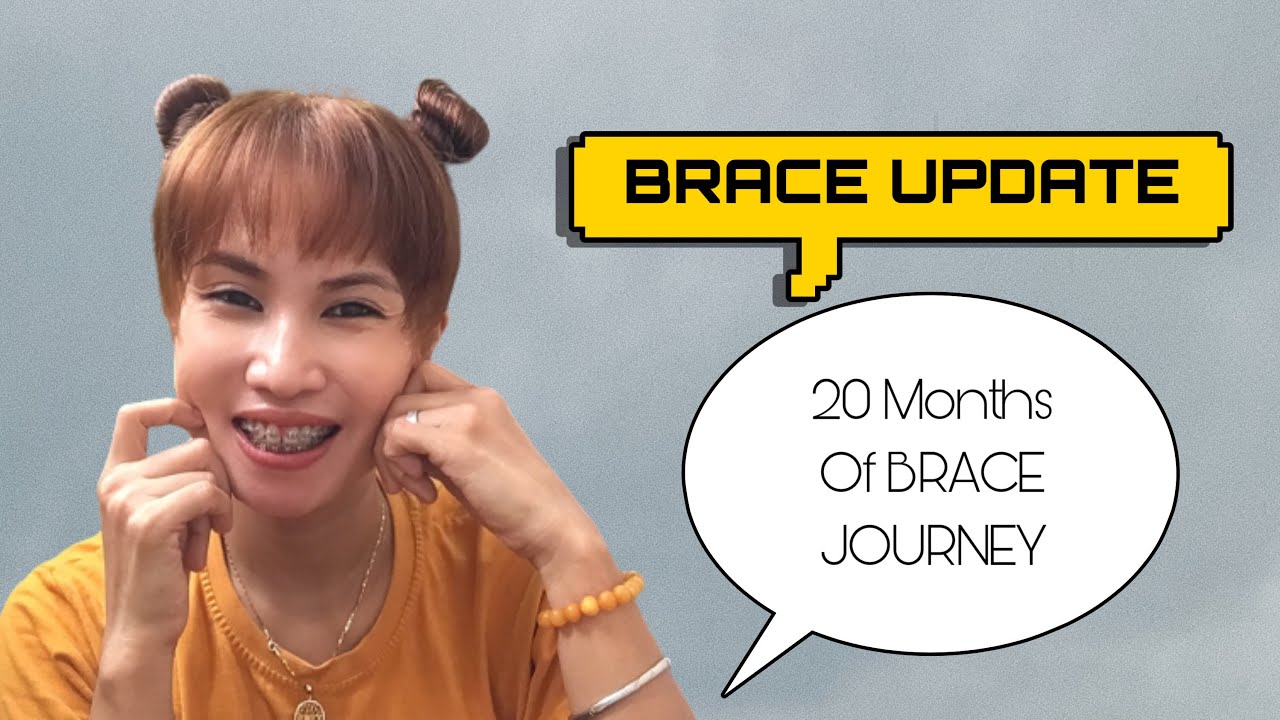 BRACE UPDATE 20 MONTHS NA /BRACE JOURNEY STORYTELLING - YouTube