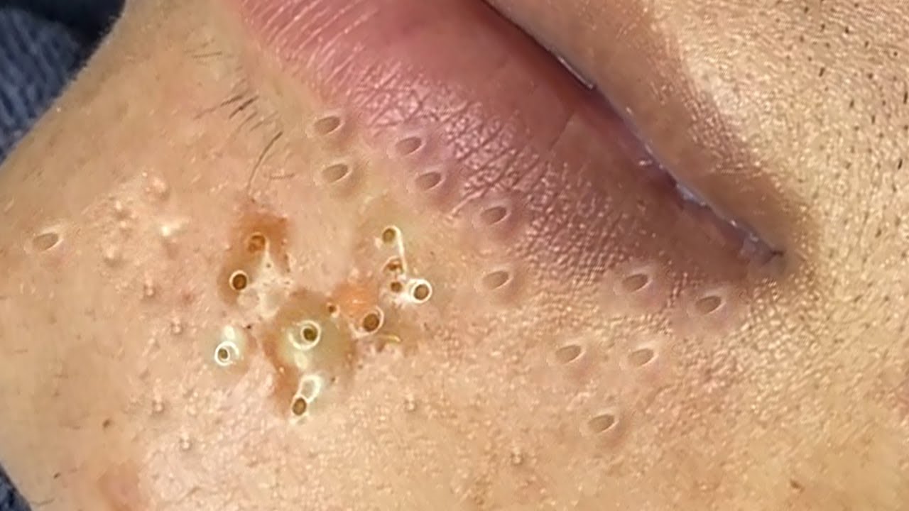 𝐄𝐱𝐭𝐫𝐞𝐦𝐞 𝐁𝐥𝐚𝐜𝐤𝐡𝐞𝐚𝐝 𝐑𝐞𝐦𝐨𝐯𝐚𝐥 𝐚𝐭 𝐋𝐍𝐆 𝐒𝐤𝐢𝐧 𝐂𝐚𝐫𝐞 # 423187 - YouTube