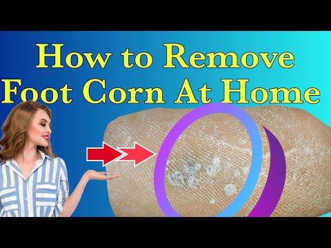 పోతుంది How to Remove Foot Corn At Home Best Medicine - YouTube
