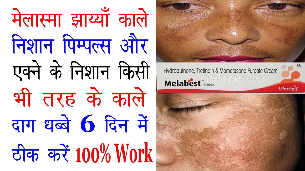 melabest cream | remove in just 7 days melasma,cholasma,all types dark ...