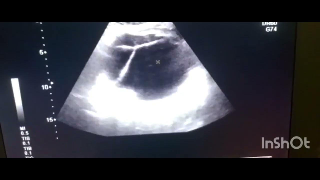 Large Uterine Dermoid Cyst With Echogenic Material inside it which ...