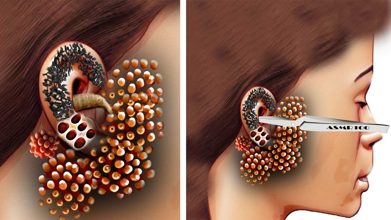 ASMR Animation Ear cleaning | Ear wax removal asmr treatment ...