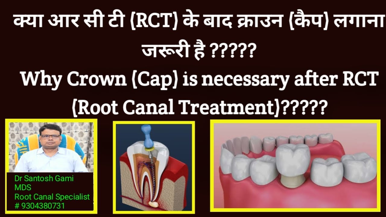 क्या आर सी टी (RCT) के बाद क्राउन (कैप) लगाना जरूरी है ? Why Crown (Cap ...