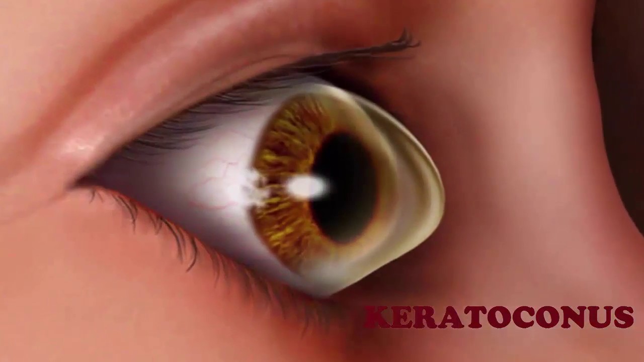 Keratoconus Explained by Dr. Charu Tyagi (Eye Surgeon) Diveeksha Eye Clinic, Noida - YouTube