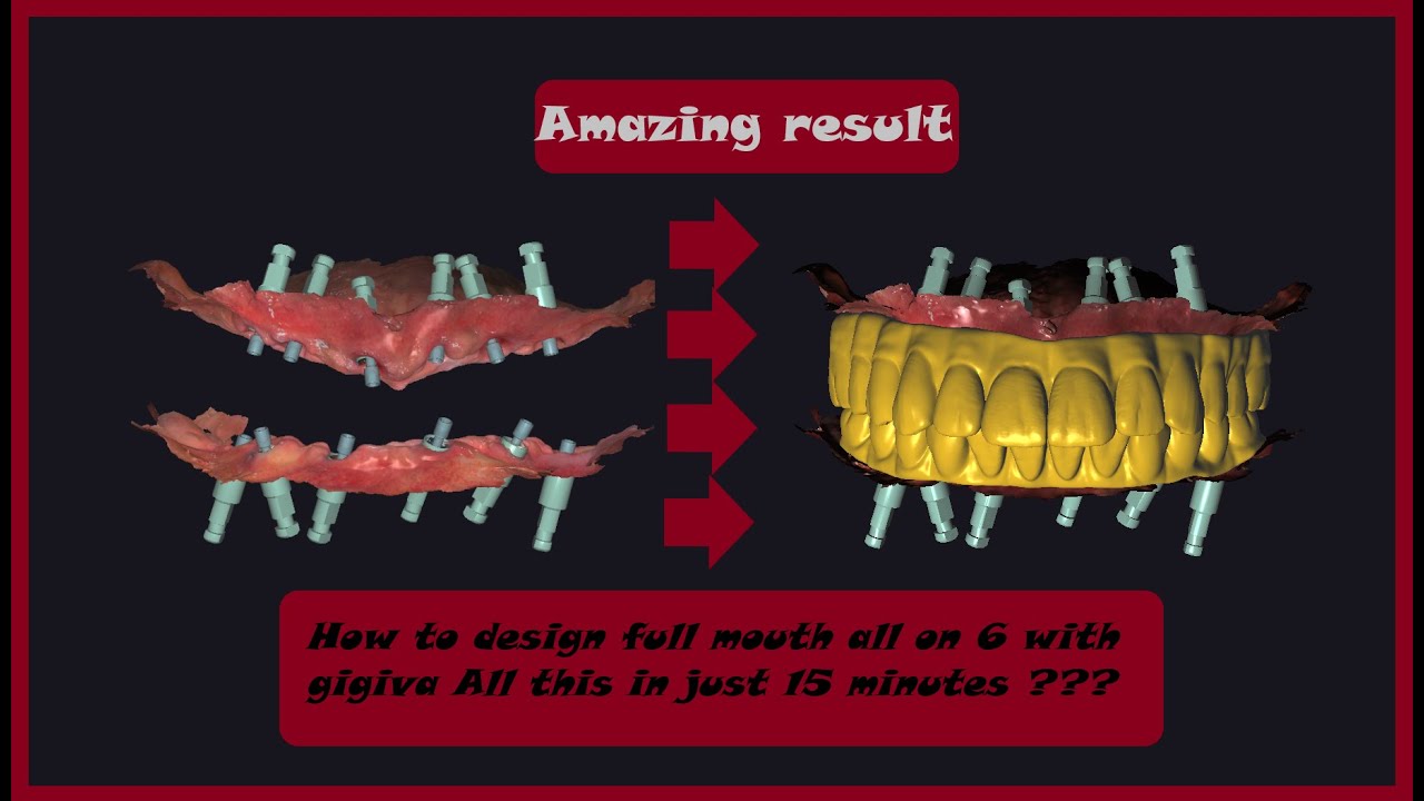 How to design full mouth all on 6 with gingiva All this in just 15 ...
