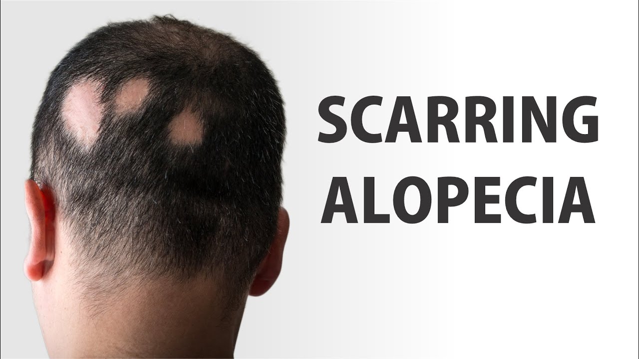 What Causes Scarring Alopecia | Diagnosis And Treating Scarring ...