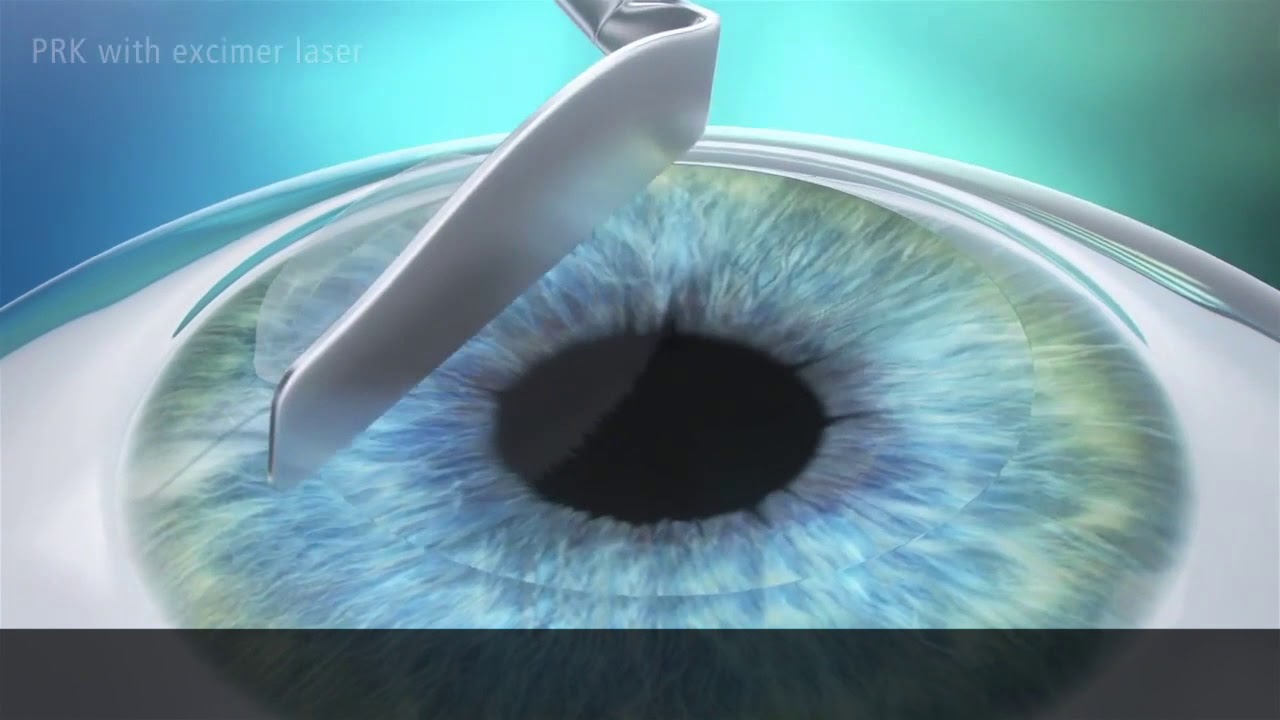LASEK TRANSPRK PRK - YouTube