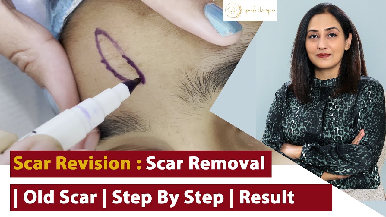 Scar Revision Surgery | Scar Removal | Old Scar | Dr. Shalu Punj - YouTube