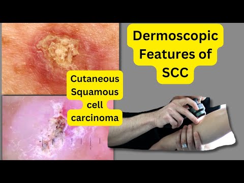 SQUAMOUS CELL CARCINOMA ON DERMOSCOPY - YouTube
