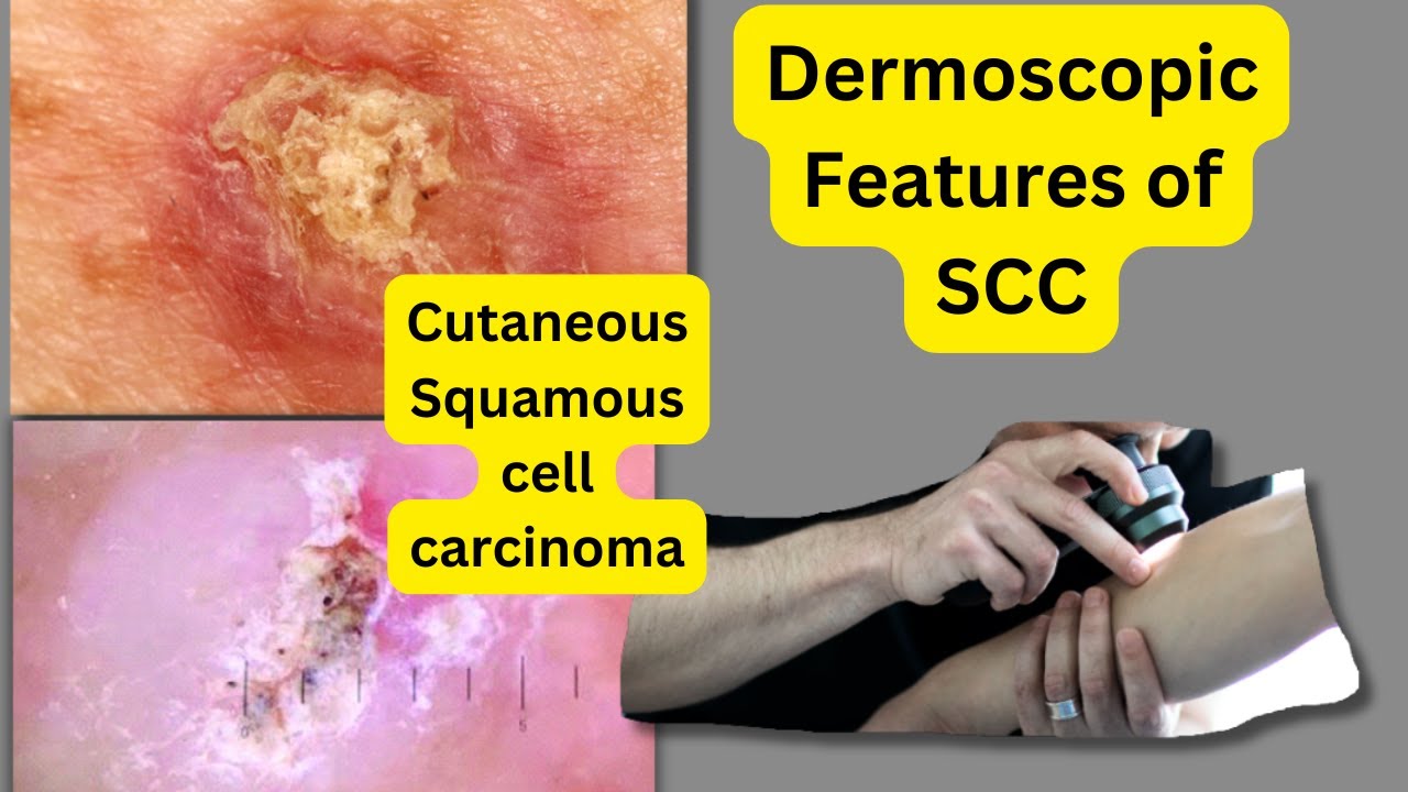 Dermoscopic features of SCC(Squamous Cell Carcinoma) - YouTube