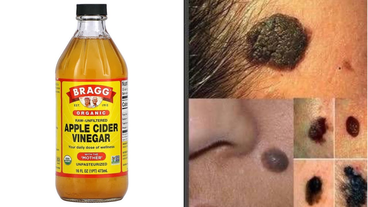How to get rid of skin tag/watt mole fast at home - YouTube