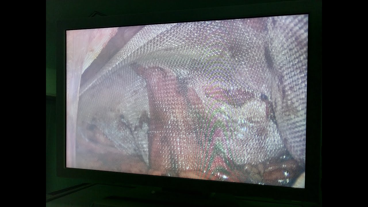 Laparoscopic right inguinal hernia (TAPP) - YouTube