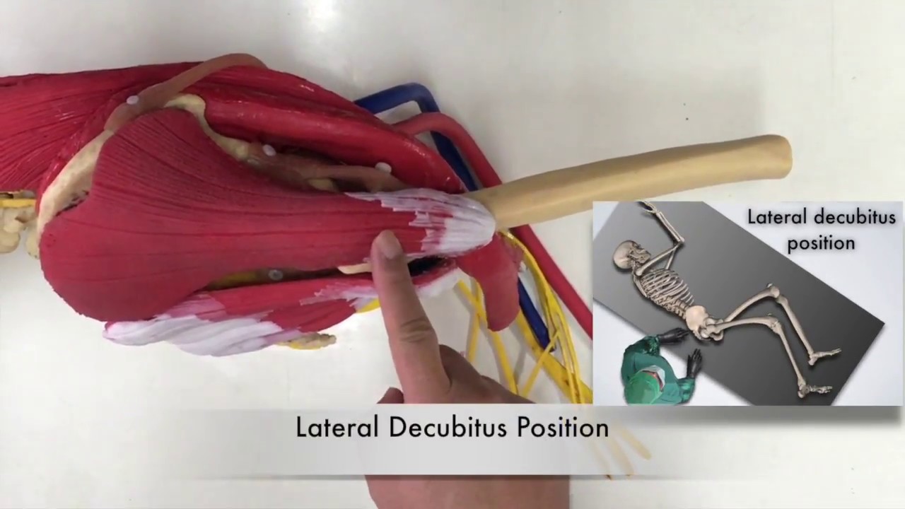 Reduction of posterior hip dislocation with push technique, Assoc. Prof ...