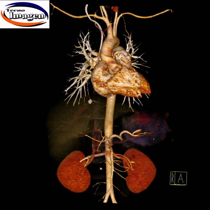 ANGIOTC TÓRAX 01.avi - YouTube