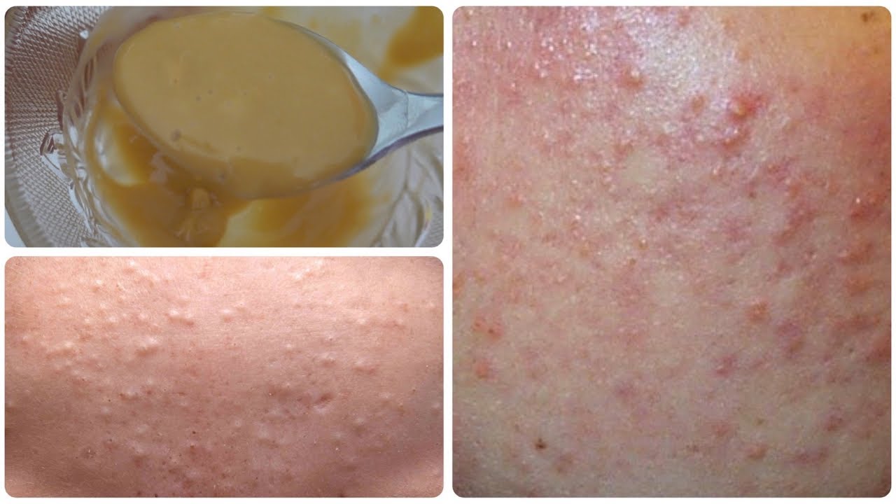 How to get rid of tiny bumps on your face - YouTube