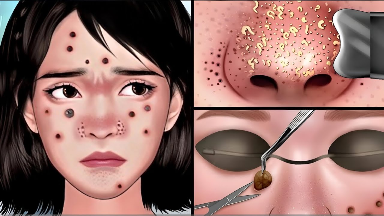 ASMR Skin Warts and Moles Removal | ASMR Sebum Removal and Skincare ...