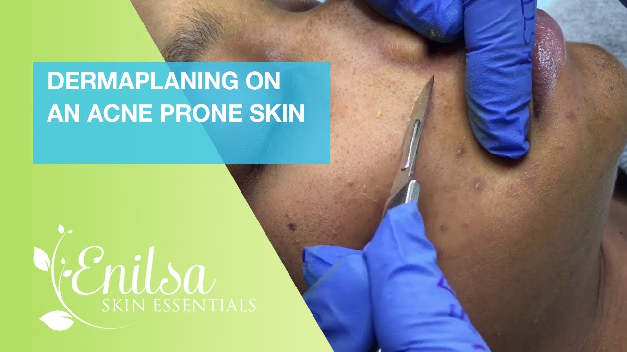 Dermaplaning On An Acne Prone Skin - YouTube