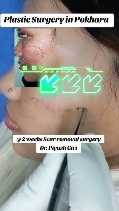 Scar removal in Pokhara Nepal. Plastic surgeon Dr Piyush Giri. #scared #scarremoval # ...