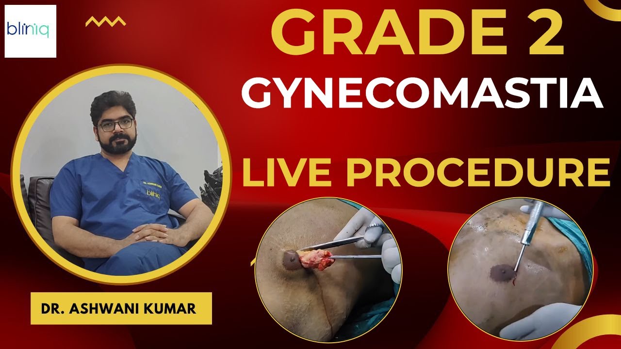 Grade 2 Gynecomastia Live Procedure | Liposuction | Male Breast ...