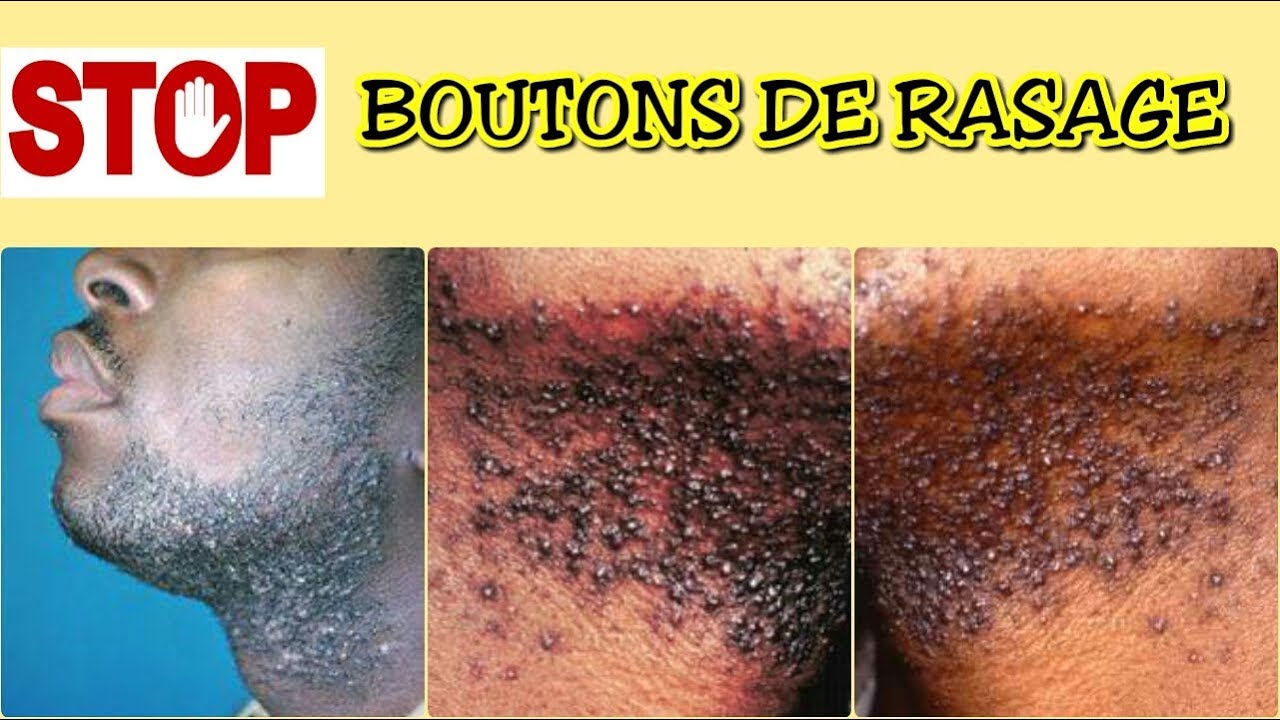 (N°27) STOP AUX BOUTONS DE RASAGE: CONSEILS ET REMEDES POUR LES EVITER ...