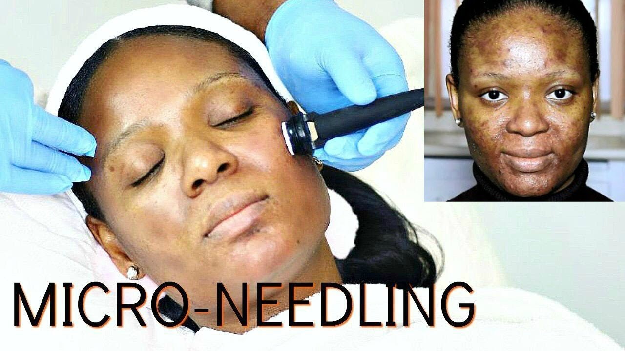MICRO-NEEDLING MY ACNE SCARS & HYPERPIGMENTATION | OMABELLETV - YouTube