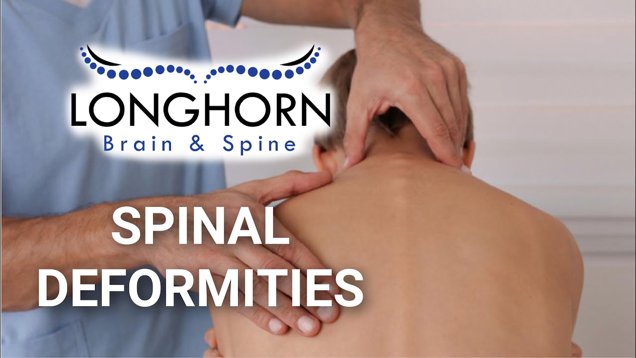 Longhorn Brain and Spine - Spinal Deformities - YouTube