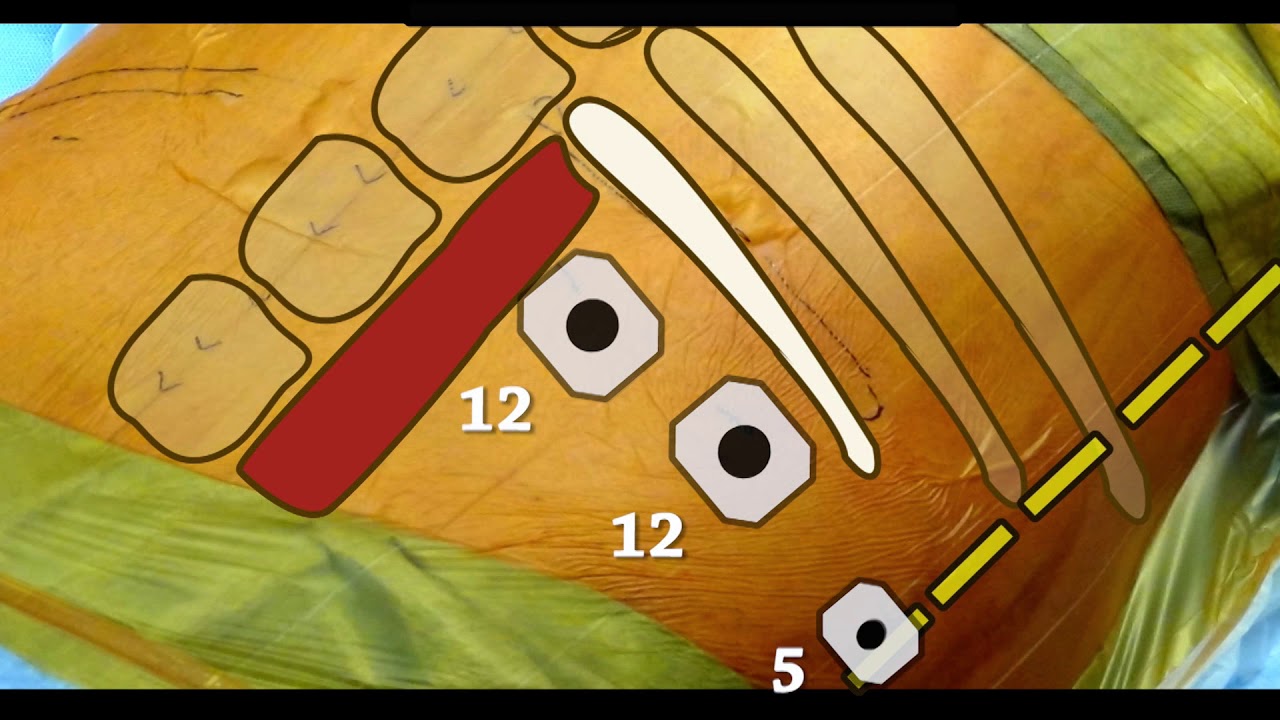 Posterior Retroperitoneoscopic Bilateral Adrenalectomy in Ectopic ...