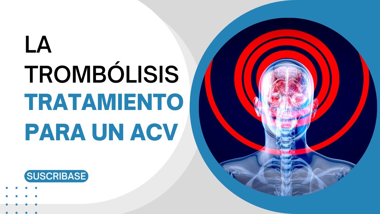 Tratamiento a tiempo de un #acv - YouTube