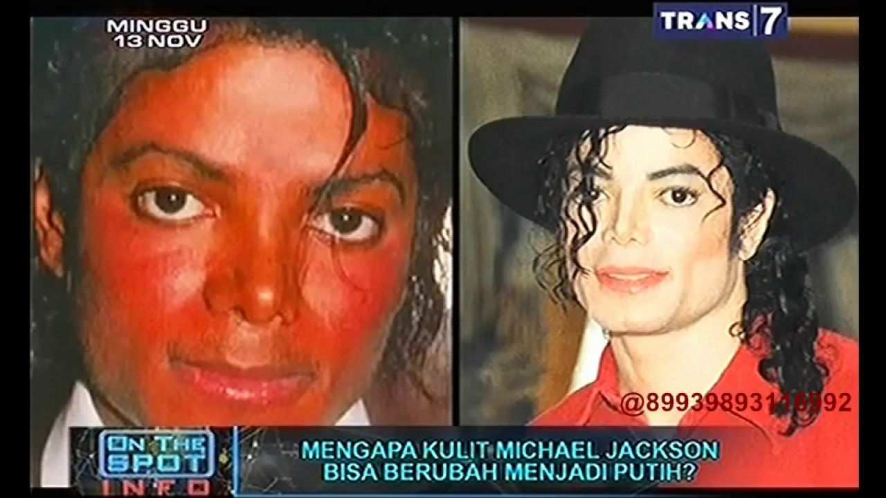 On The Spot - Mengapa Kulit Michael Jackson bisa Berubah Menjadi Putih ...