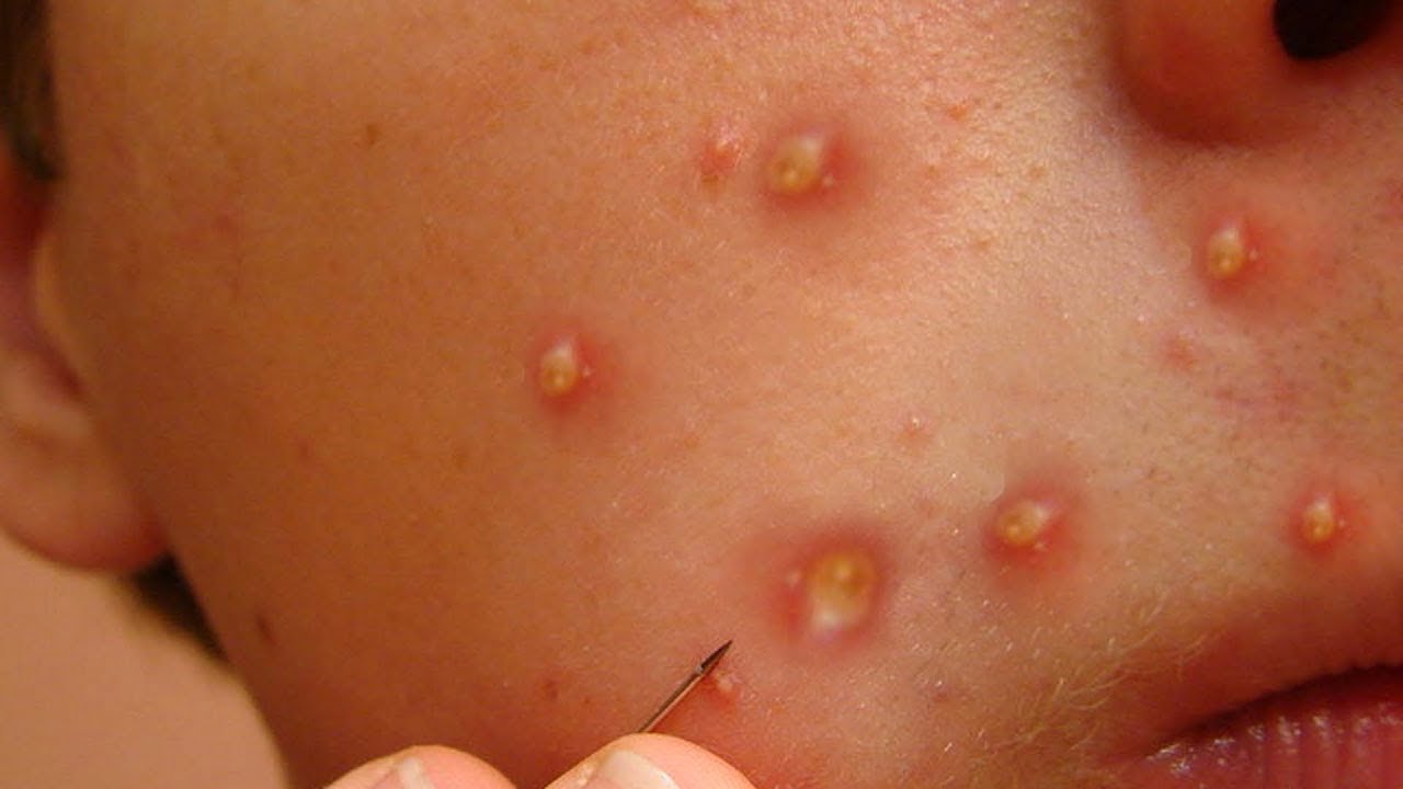 AMAZING Popping huge blackheads and Pimple Popping - INGENIOUS Pimple ...