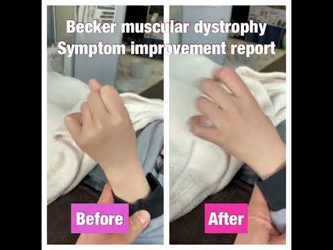 Becker muscular dystrophy treatment record - YouTube