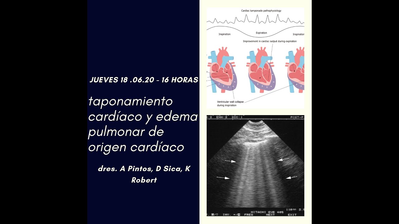 edema pulmonar de origen cardíaco, taponamiento cardíaco, caso clínico ...