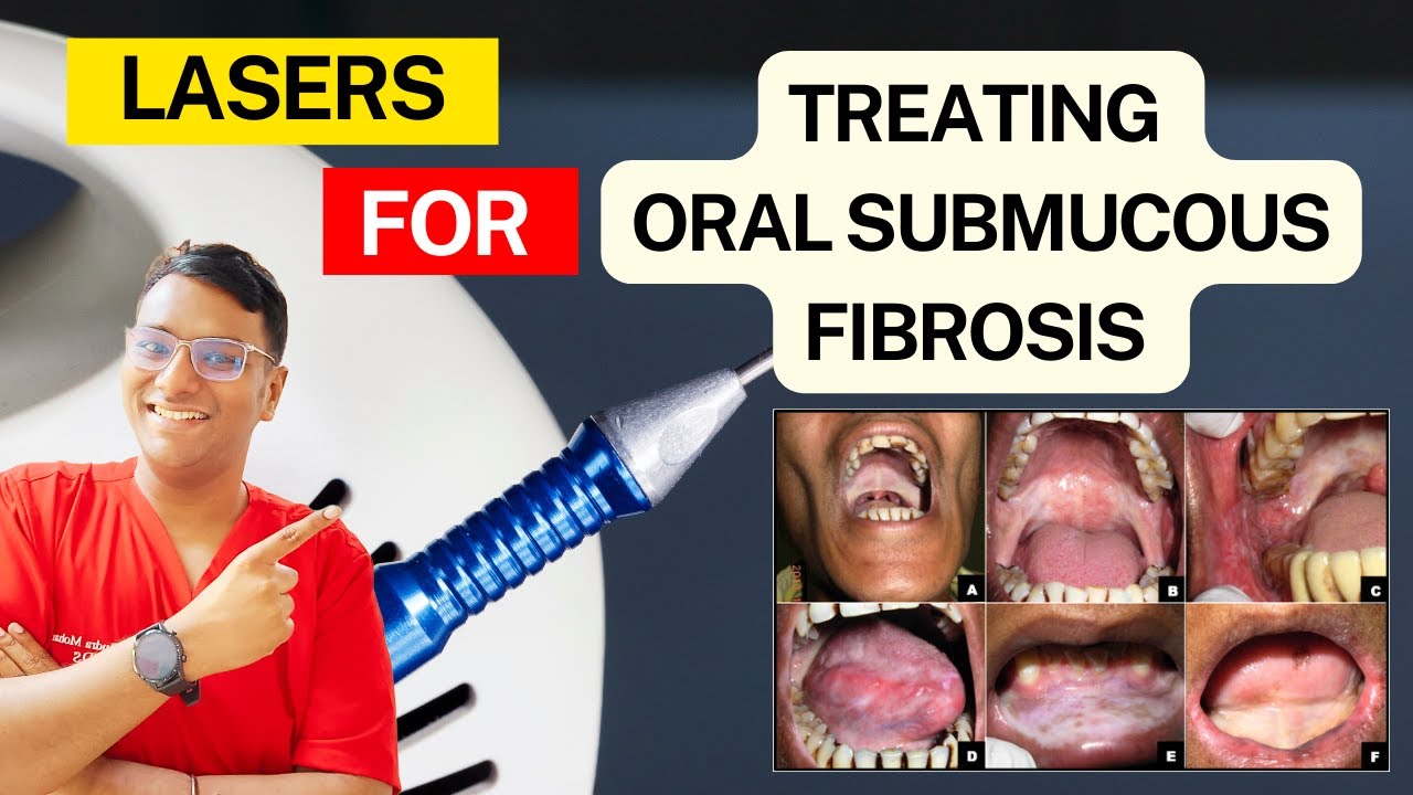 Dr Rudra Mohan | Oral Submucous FIbrosis Treatment with Laser Therapy | OSMF Treatment| Diode ...
