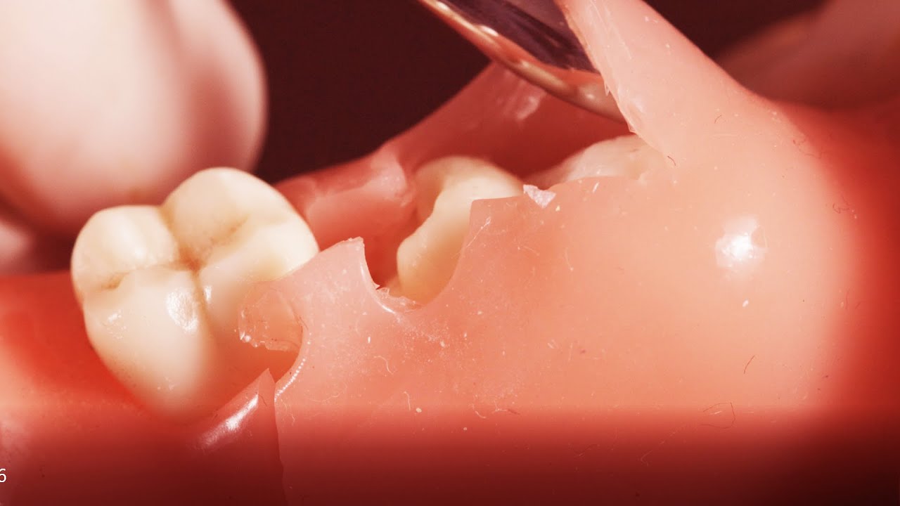 Surgical extraction of partially impacted wisdom tooth as you have ...