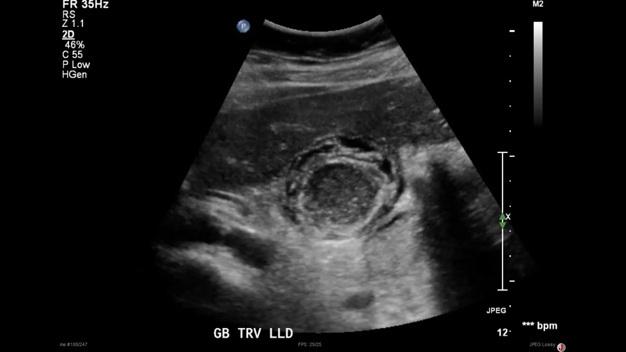 Emphysematous Cholecystitis Ultrasound