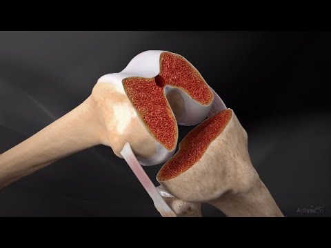 iBalance® TKA Ligament Balancing Surgical Technique - YouTube