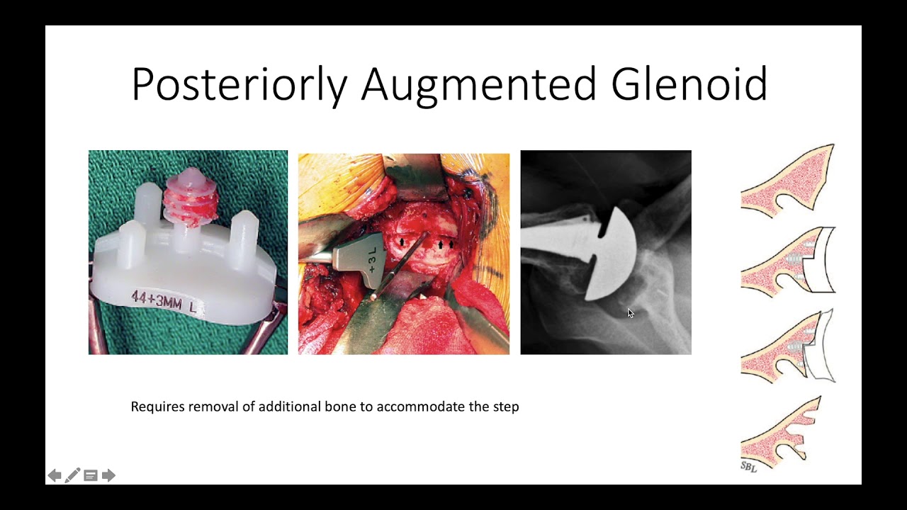 How To Do a Total Shoulder #5: Managing Glenoid Retroversion - YouTube