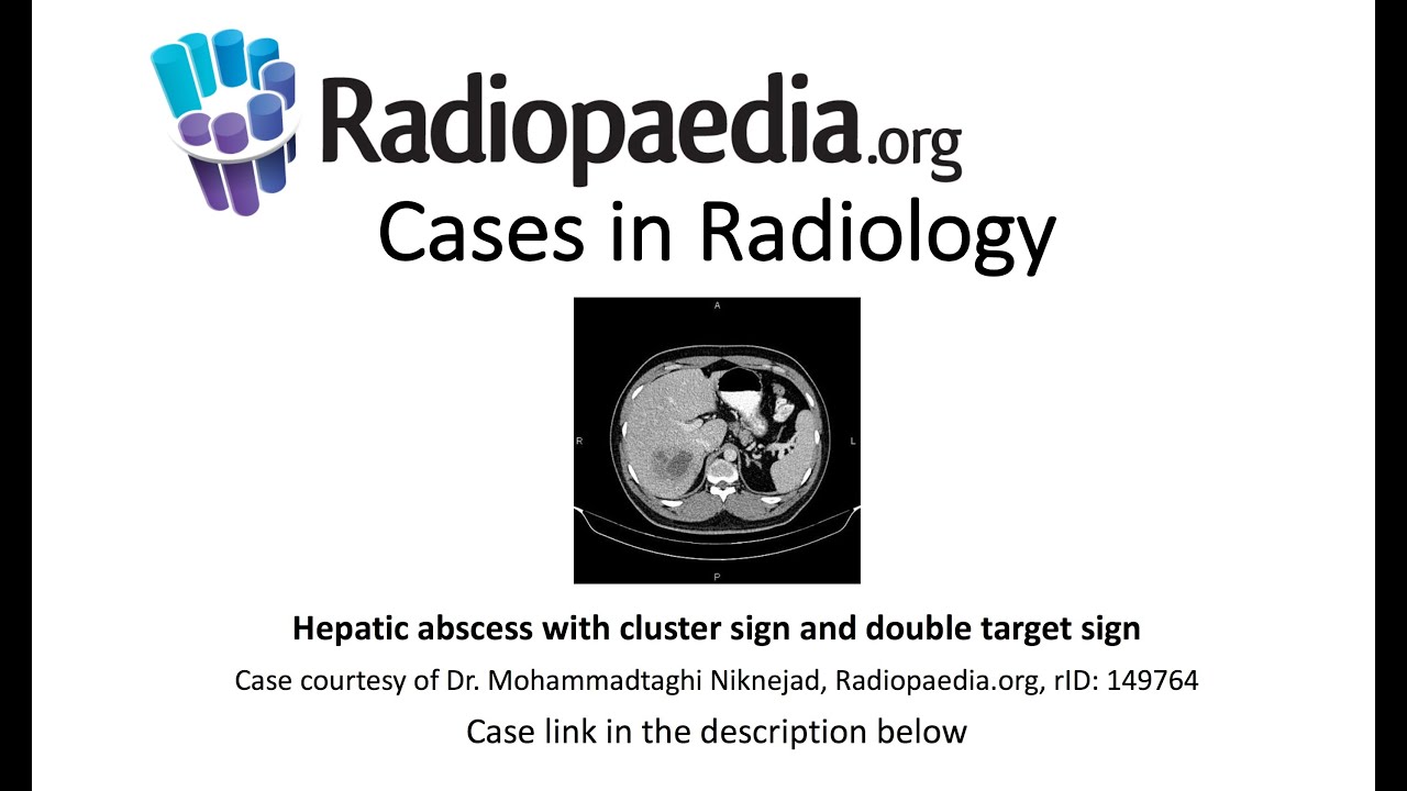 Hepatic abscess with cluster sign and double target sign (Radiopaedia ...