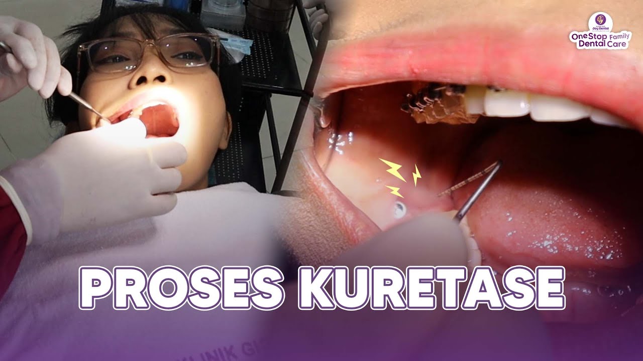 PROSES KURATASE DIAPAIN AJA SIH? - YouTube
