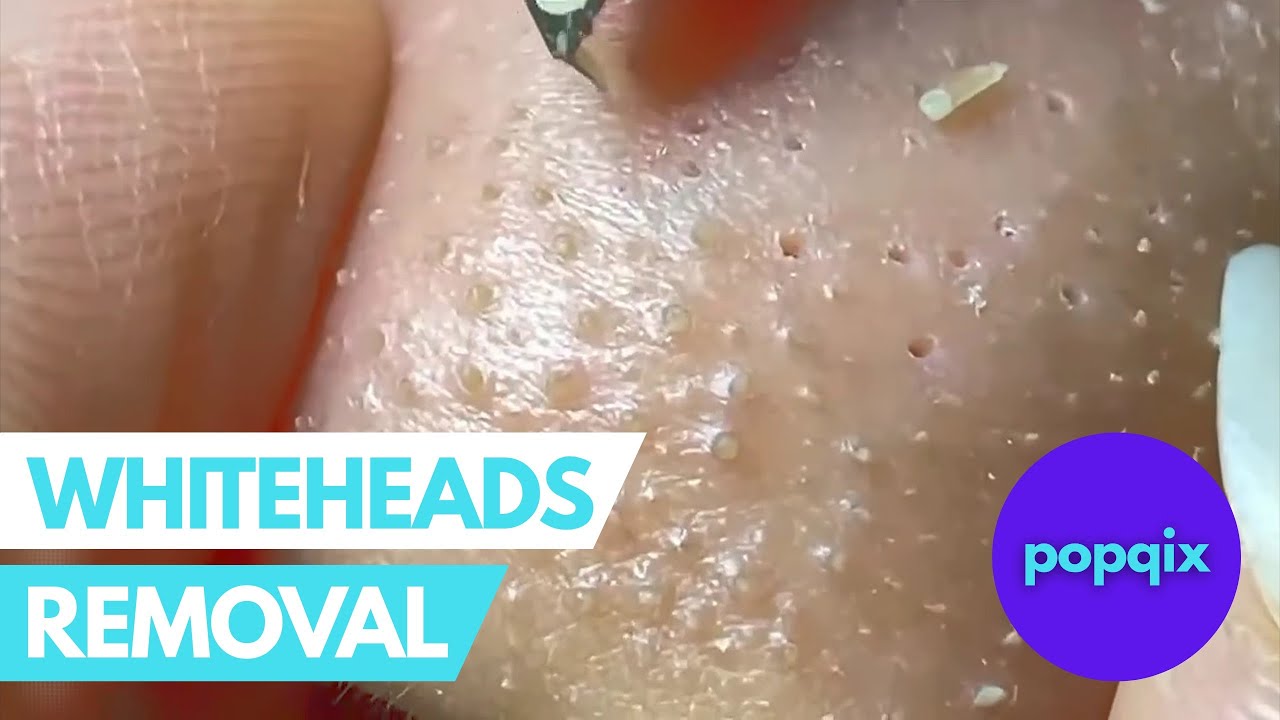 How to Remove Whiteheads from Your Nose (The RIGHT WAY) - YouTube